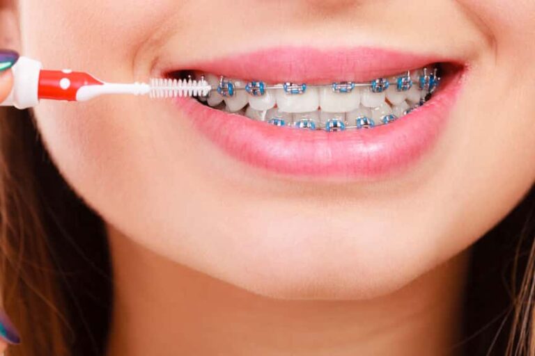 Braces Care Lake Stevens, WA — Lund Orthodontics